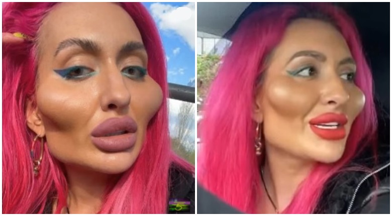 VIDEO | She injected the fillers herself: Anastasia is the owner of the ...